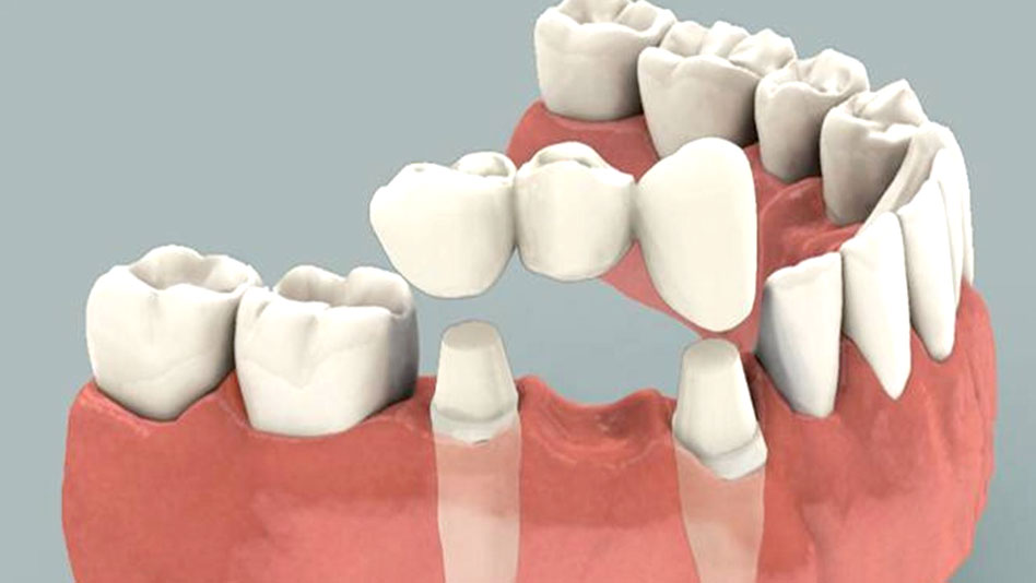 PORCELAIN FIXED BRIDGES - Capital Dental Care